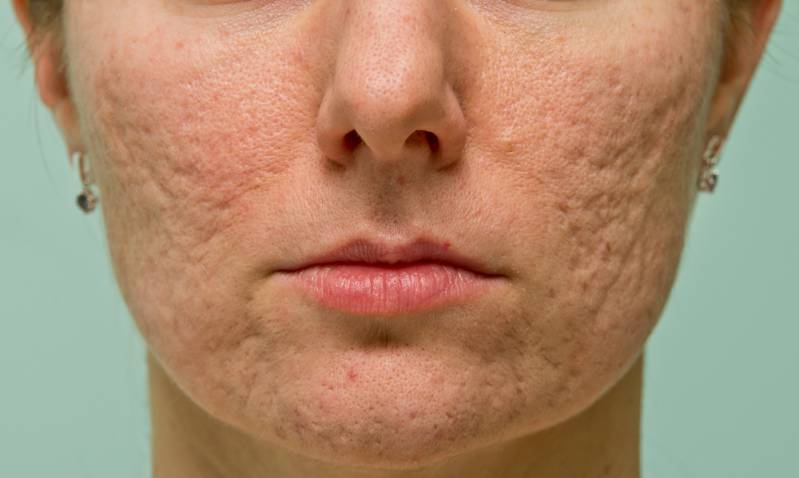 Pitted Acne Scars Causes, Types And How To Get Rid Of Them - Healthality